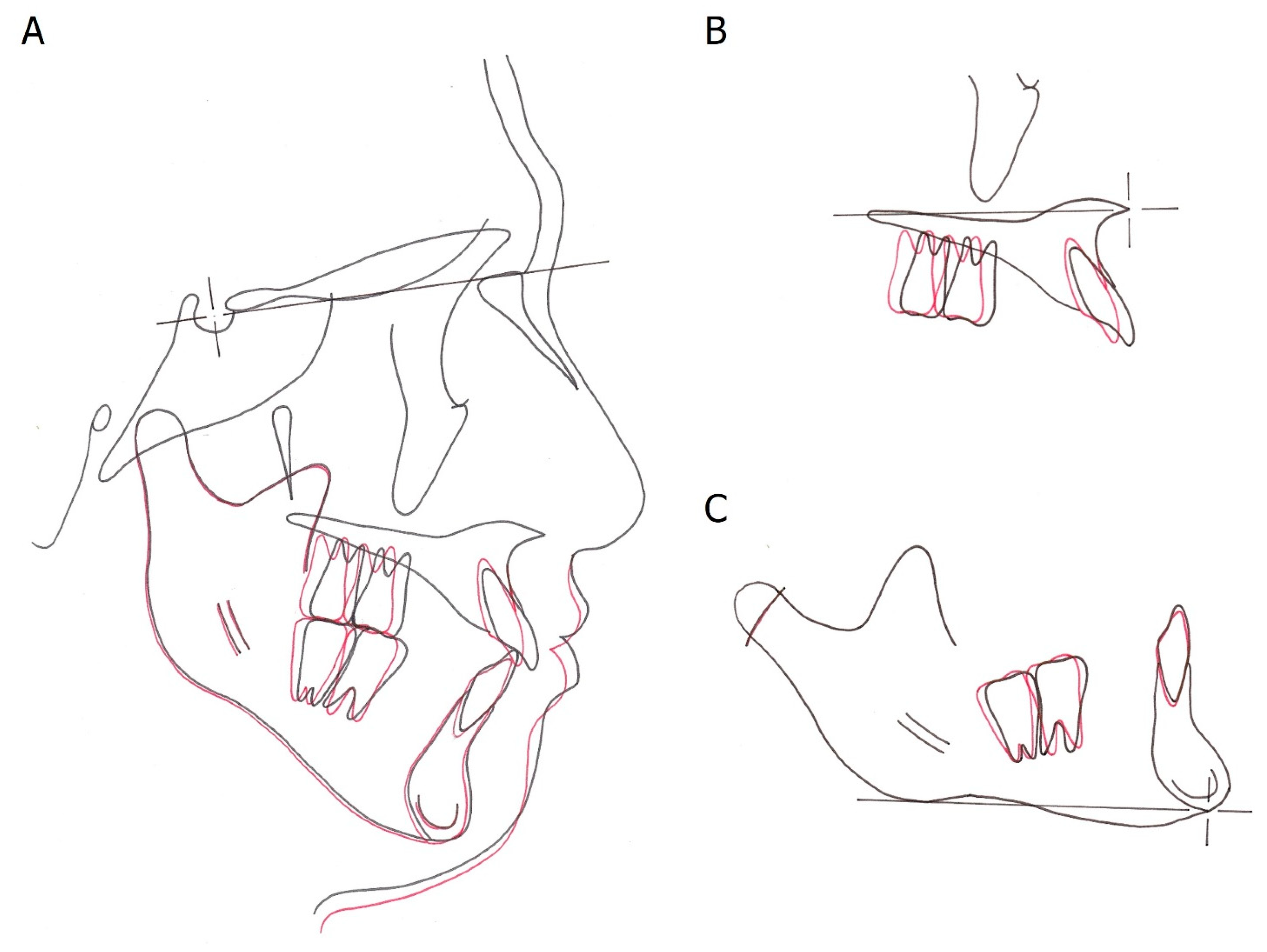 A Case Treated with Maxillary Molar Distalization through the Maxillary ...