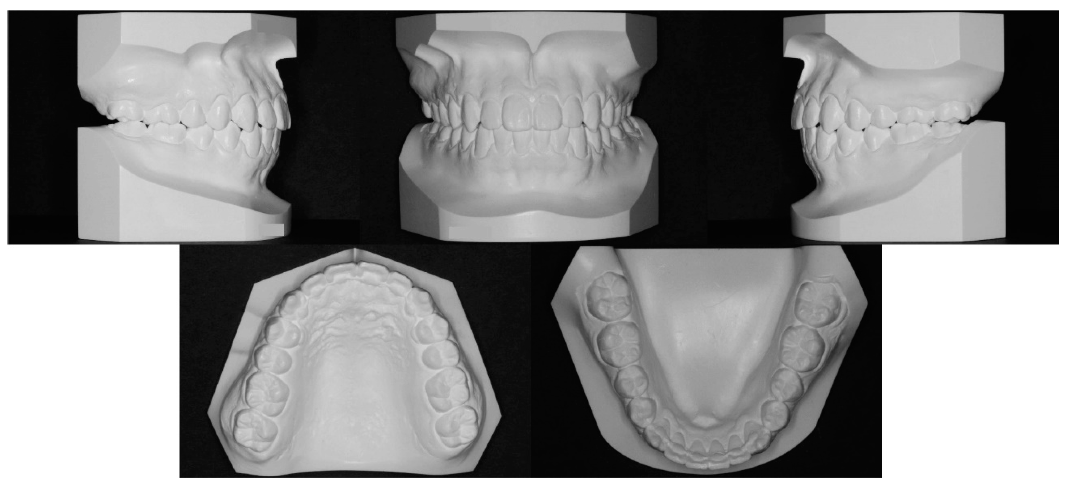 A Case Treated with Maxillary Molar Distalization through the Maxillary ...