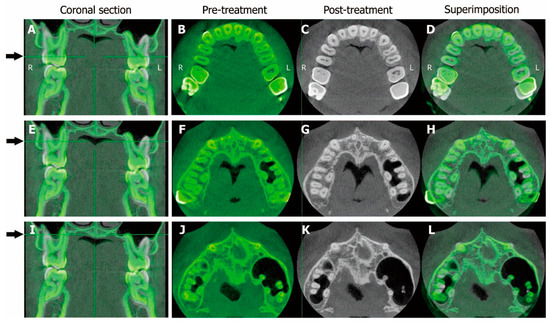 A Case Treated with Maxillary Molar Distalization through the Maxillary ...