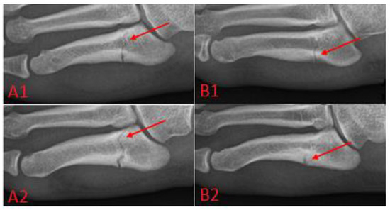 Analytical, Stochastic and Experimental Solution of the Osteosynthesis ...