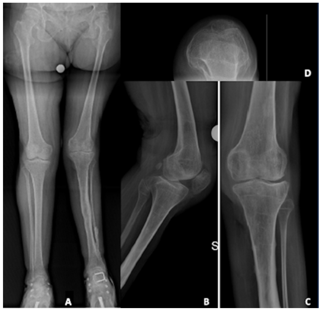 Three Dimensional Printed Models In Pre Operative Planning Of Complex Primary And Revision Total