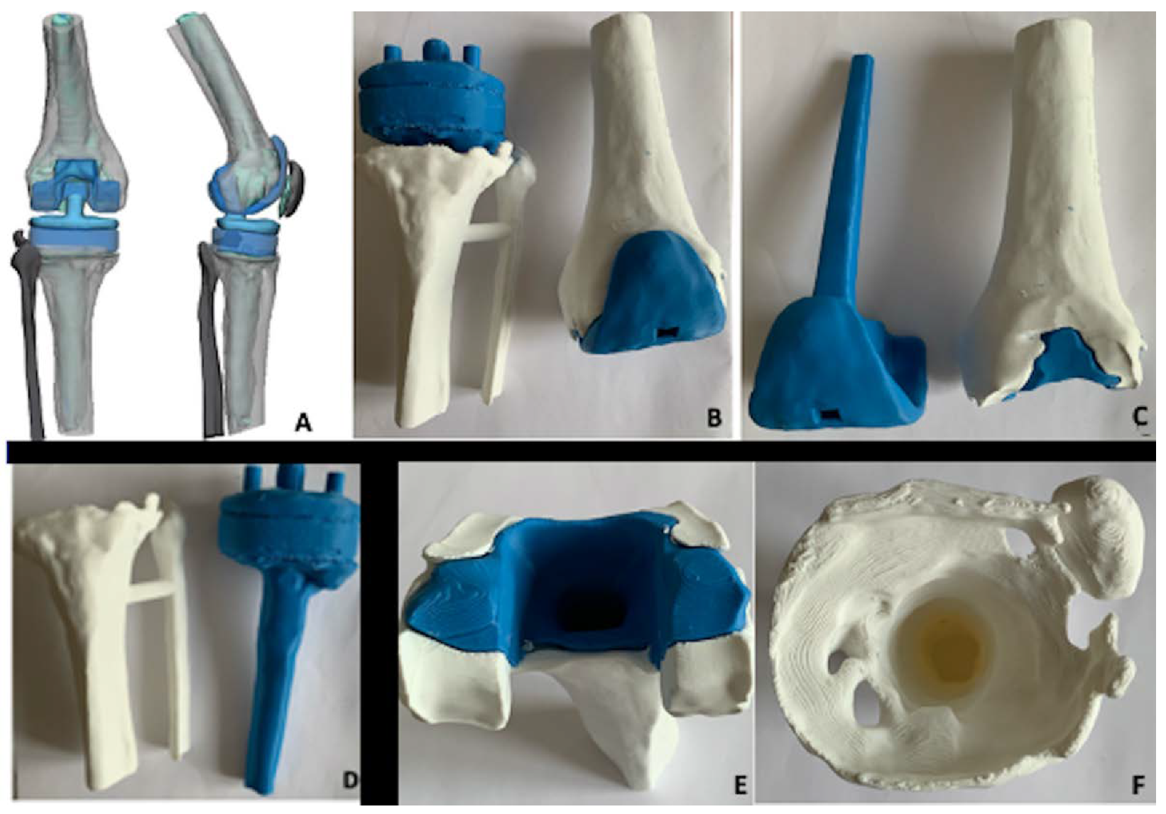 Three-Dimensional Printed Models in Pre-Operative Planning of Complex ...