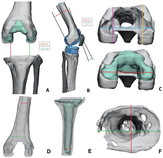 Three-Dimensional Printed Models in Pre-Operative Planning of Complex ...