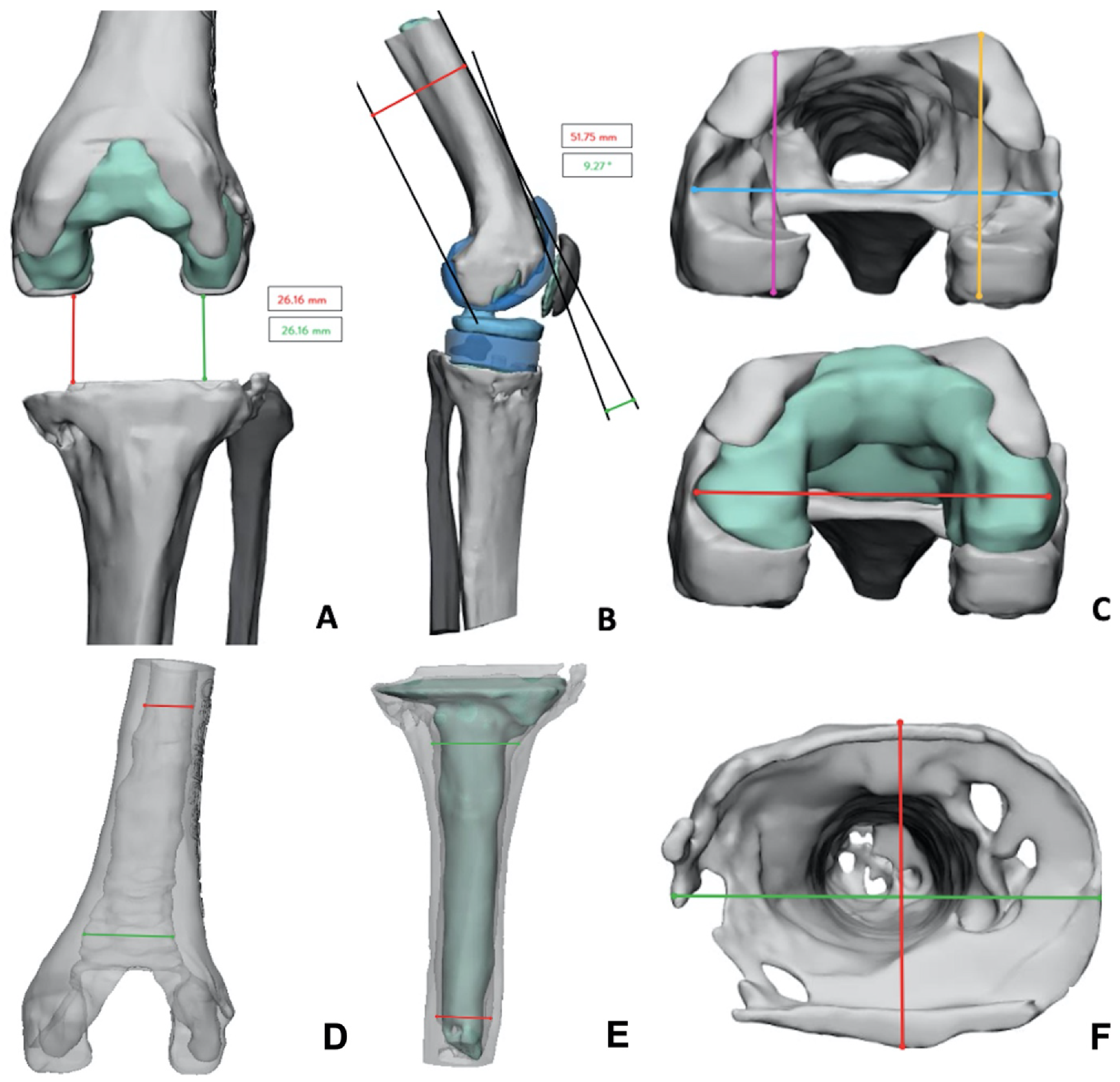 Three-Dimensional Printed Models in Pre-Operative Planning of Complex ...
