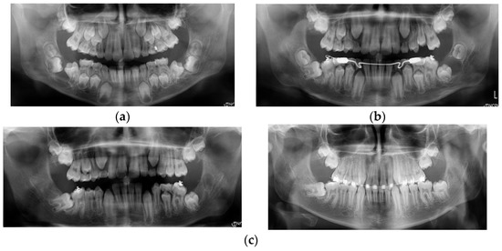 Root Dilaceration and Dentigerous Cyst—A Cause–Effect Relationship ...