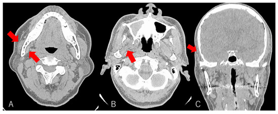 Trigeminal Schwannoma Presenting with Masticatory Muscle Atrophy: A ...