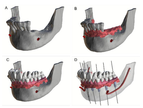Reverse Guided Bone Regeneration (R-GBR) Digital Workflow for Atrophic ...
