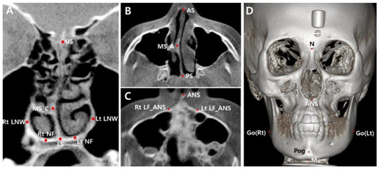 A CBCT Evaluation of Nasal Septal Deviation and Related Nasofacial ...