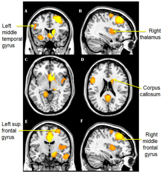 A Systematic Review and Meta-Analysis of the Grey Matter Volumetric Changes in Mild Traumatic ...