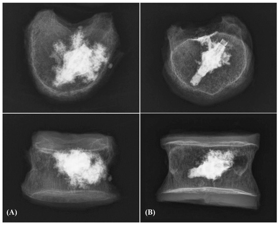 Biomechanical Evaluation of a Novel Expandable Vertebral Augmentation ...
