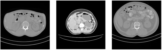 Abdomen Fat and Liver Segmentation of CT Scan Images for Determining ...