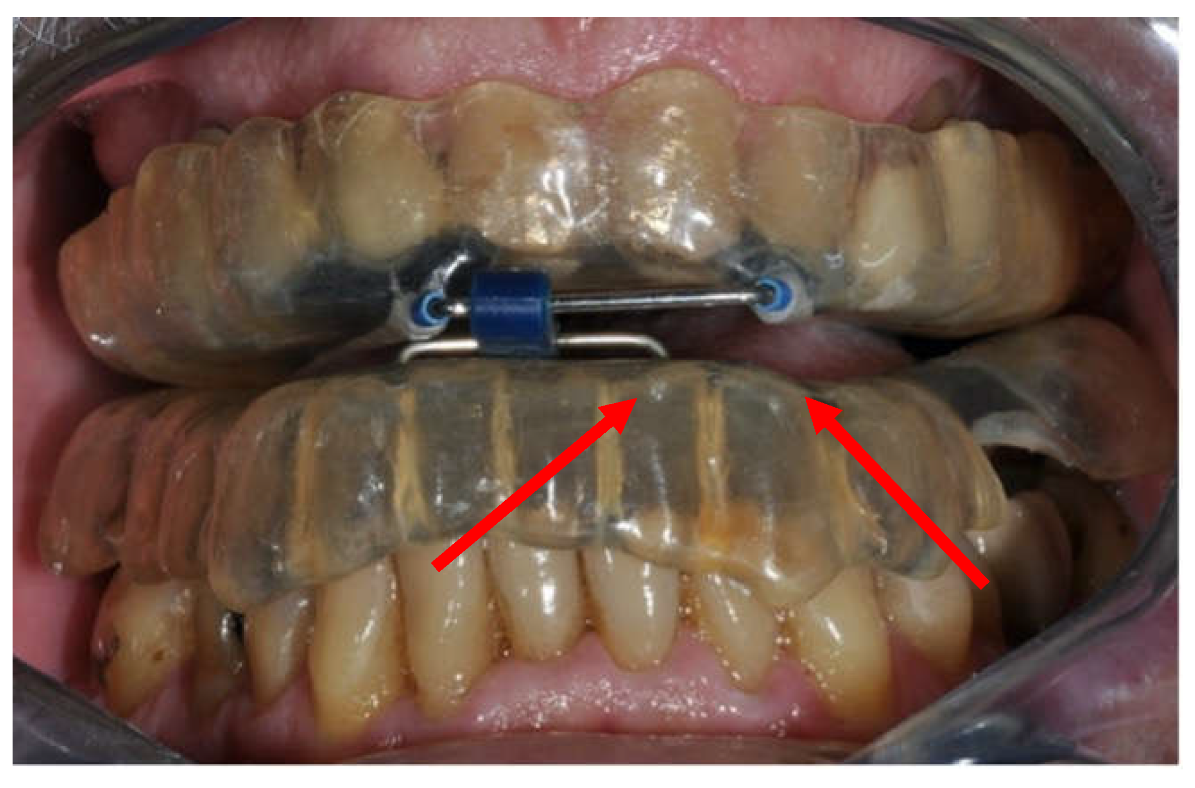 Oral Appliances For Severe Positional Obstructive Sleep Apnea Syndrome