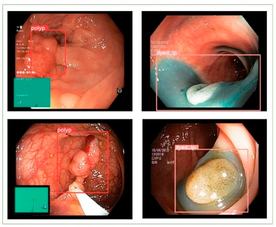 An Improved Method of Polyp Detection Using Custom YOLOv4-Tiny