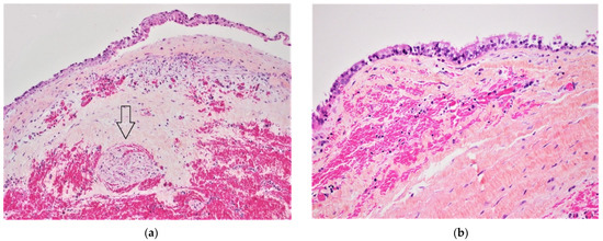 Incisive Canal Cyst Histology