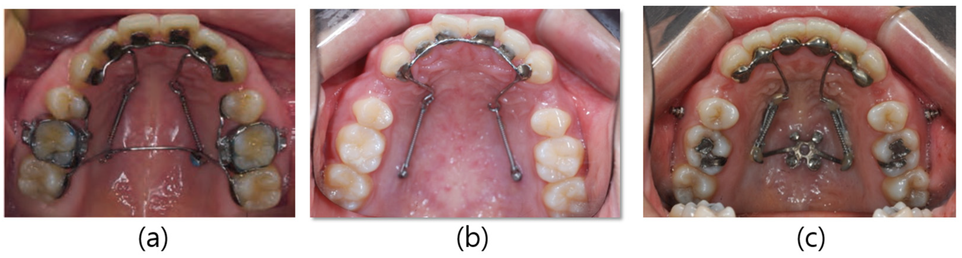 Clinical Application and Biomechanics of Various Lingual Retractors ...