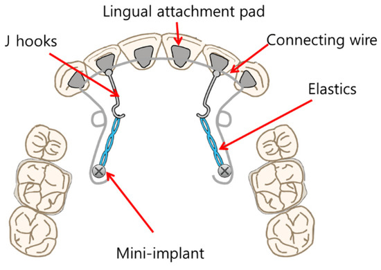 Clinical Application and Biomechanics of Various Lingual Retractors ...