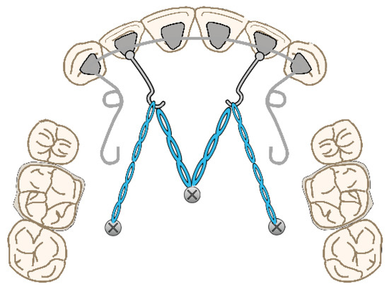 Clinical Application and Biomechanics of Various Lingual Retractors ...