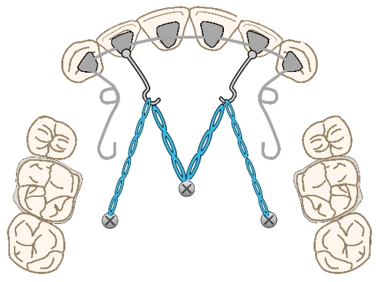 Clinical Application and Biomechanics of Various Lingual Retractors ...