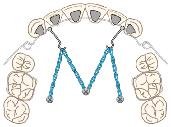 Clinical Application and Biomechanics of Various Lingual Retractors ...