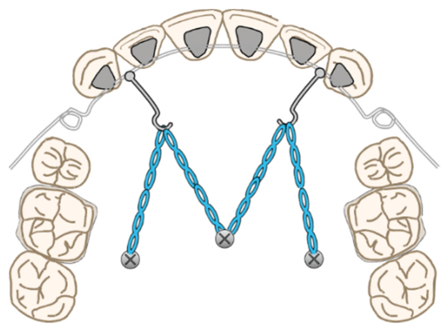 Clinical Application and Biomechanics of Various Lingual Retractors ...