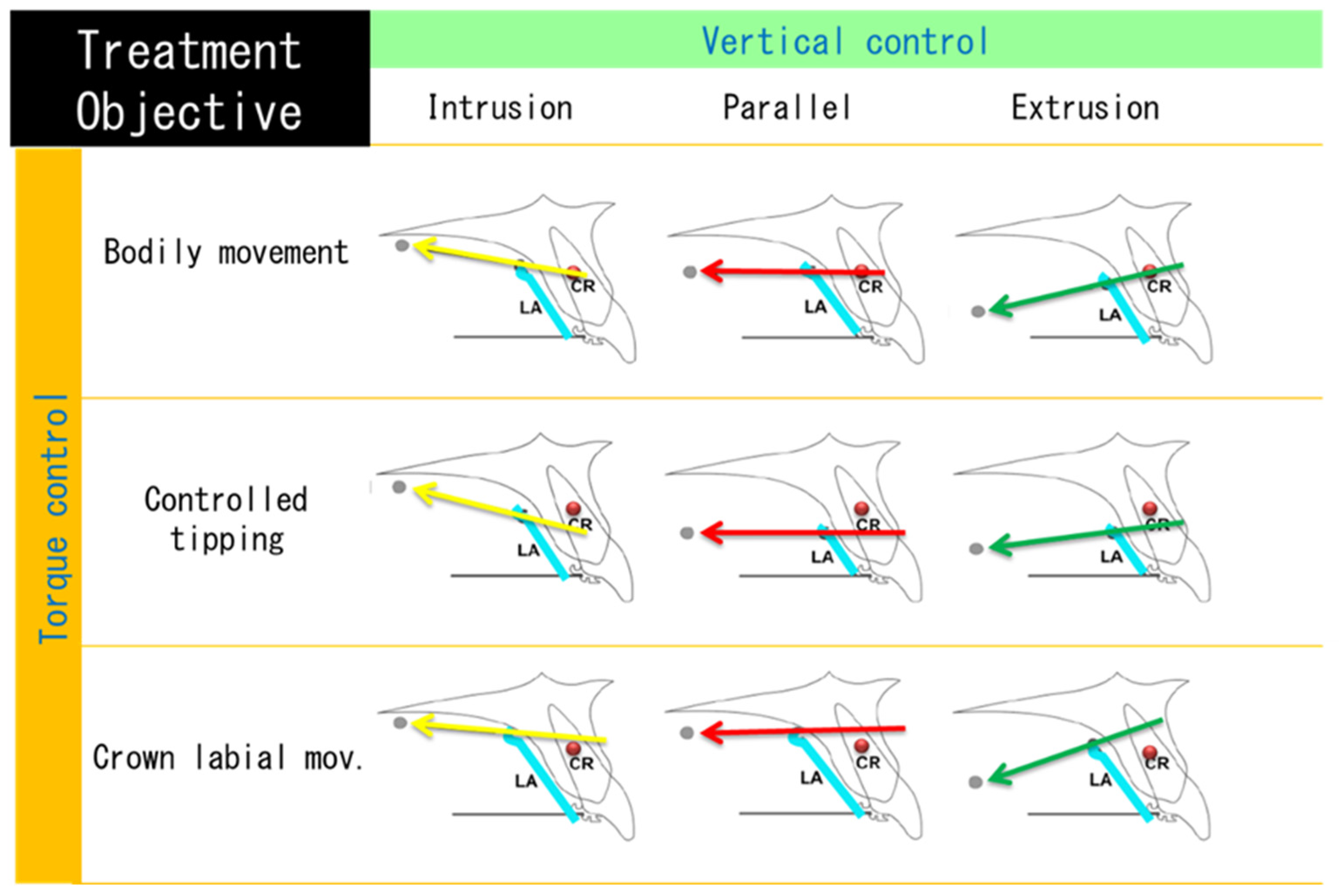 Clinical Application and Biomechanics of Various Lingual Retractors ...