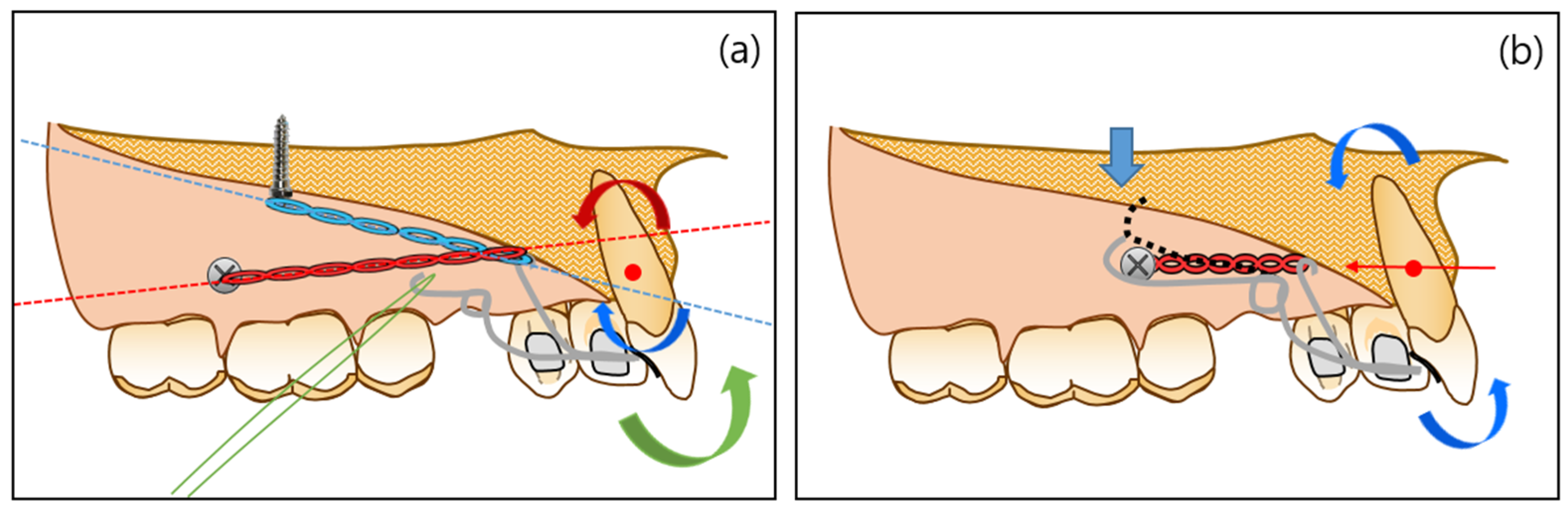 Clinical Application and Biomechanics of Various Lingual Retractors ...