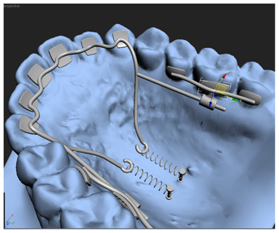 Clinical Application and Biomechanics of Various Lingual Retractors ...