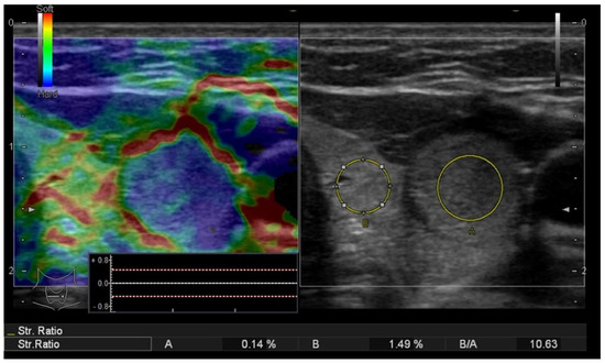 Strain Versus 2D Shear-Wave Elastography Parameters—Which Score Better ...