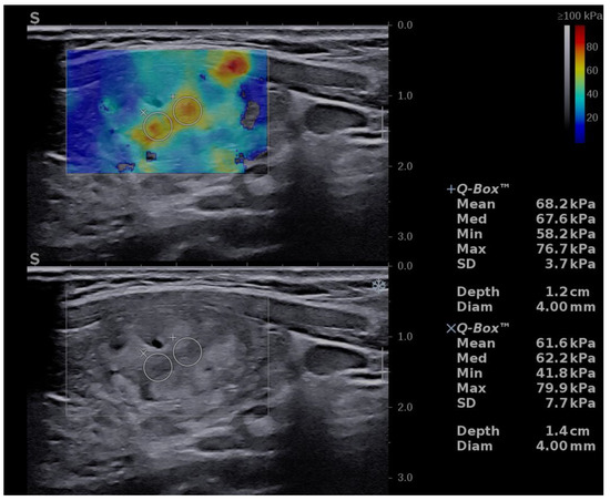 Strain Versus 2D Shear-Wave Elastography Parameters—Which Score Better ...