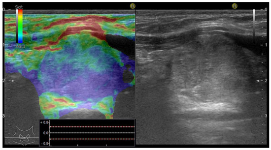 Strain Versus 2D Shear-Wave Elastography Parameters—Which Score Better ...