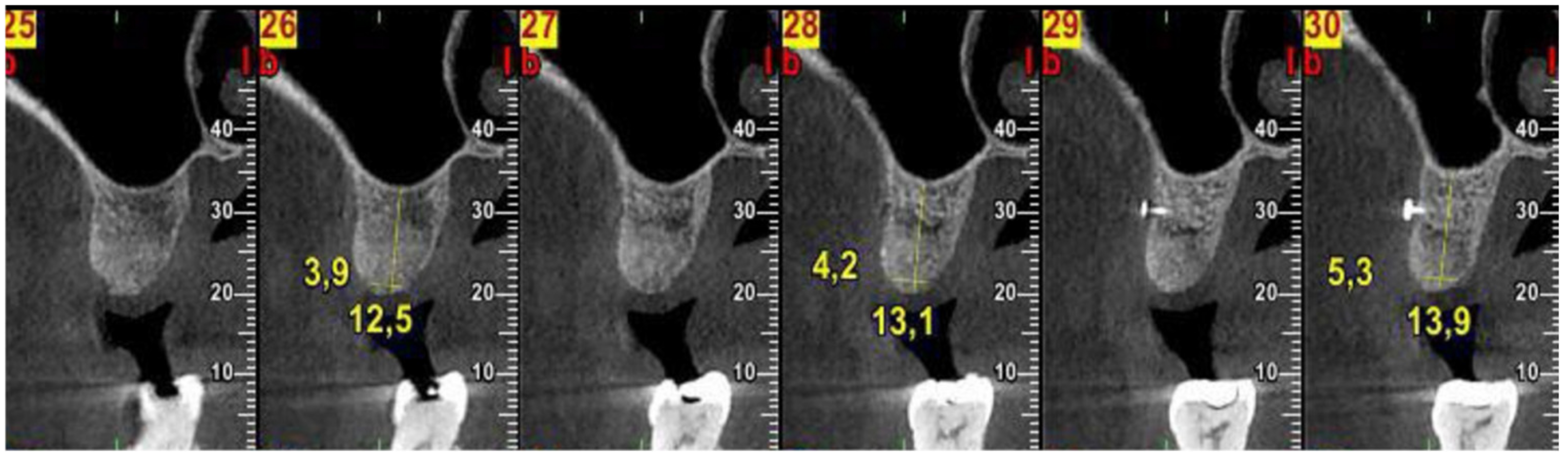 The ‘Guided Tissue Regeneration (GTR) Effect’ of Guided Bone ...