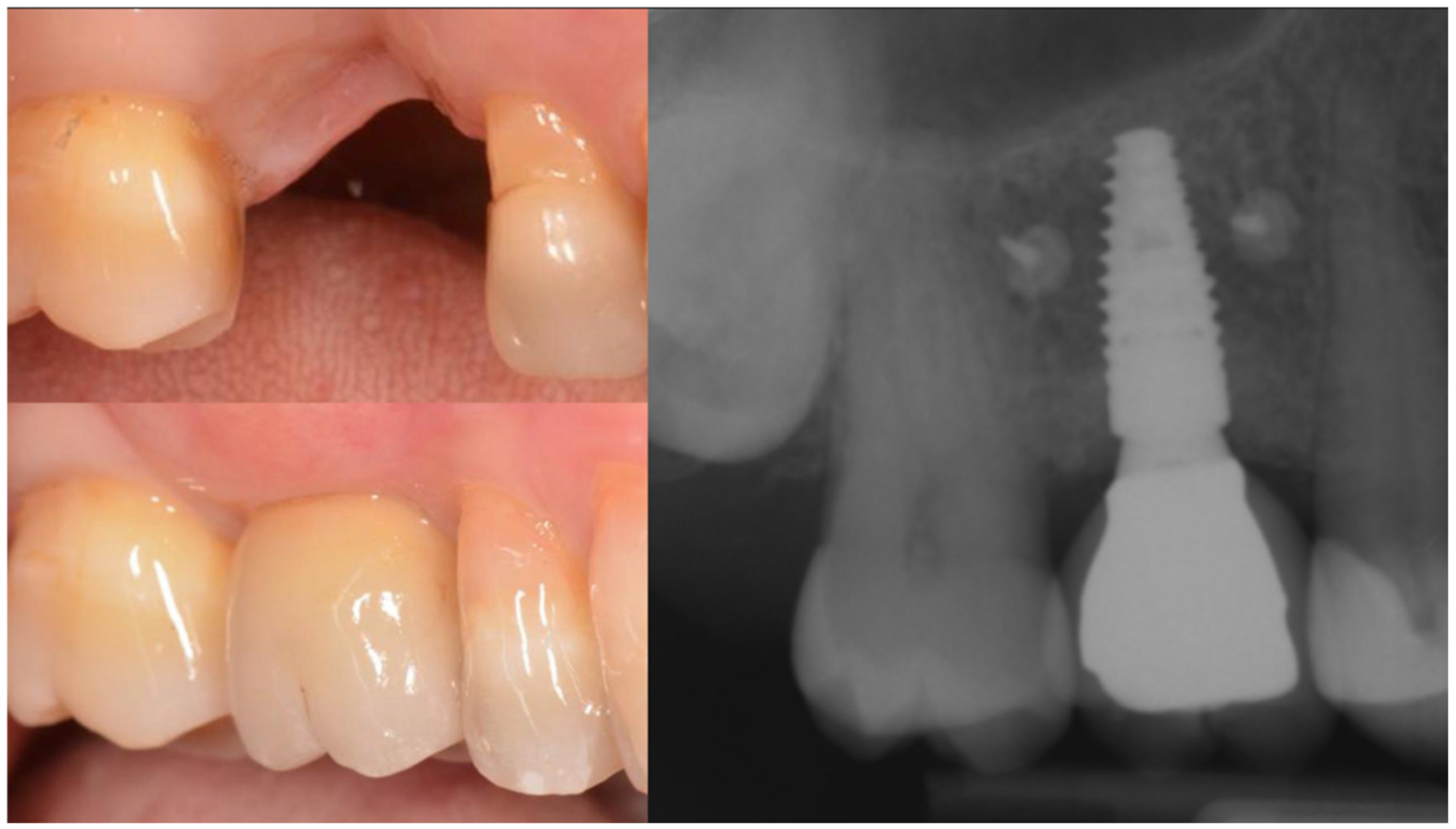 The ‘Guided Tissue Regeneration (GTR) Effect’ of Guided Bone ...