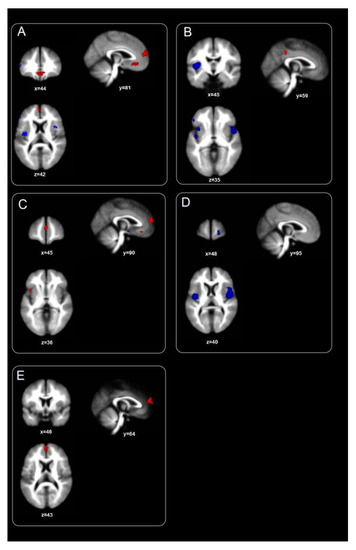 Do Psychogenic Erectile Dysfunction and Premature Ejaculation Share a ...