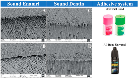 SEM Evaluation of the Hybrid Layer of Two Universal Adhesives on Sound ...
