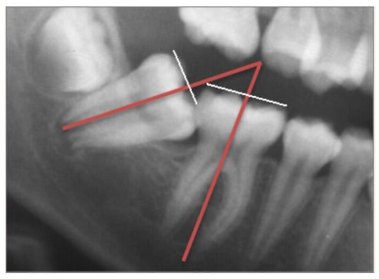 Mandibular Second Molar Impaction-Part II: Etiology and Role of the ...