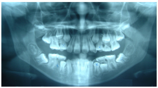 Mandibular Second Molar Impaction-Part II: Etiology and Role of the ...