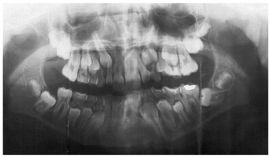 Mandibular Second Molar Impaction-Part II: Etiology and Role of the ...