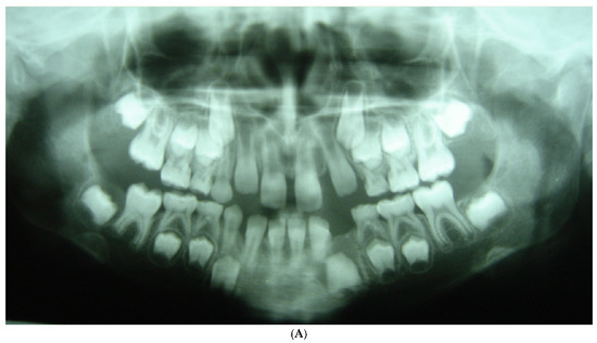 Mandibular Second Molar Impaction-Part II: Etiology and Role of the ...