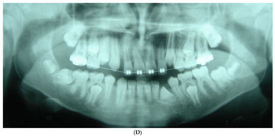 Mandibular Second Molar Impaction-Part II: Etiology and Role of the ...