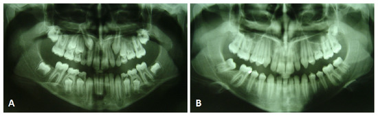 Mandibular Second Molar Impaction-Part II: Etiology and Role of the ...