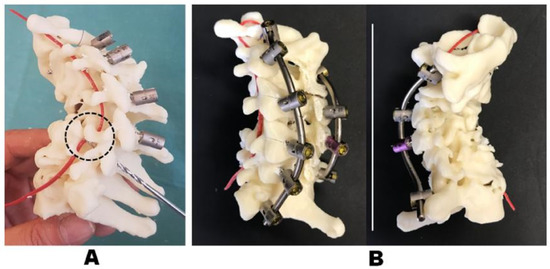 3D Printing in Surgical Planning and Intra-Operative Assistance: A Case ...