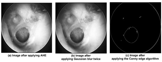 Semantic Decomposition and Anomaly Detection of Tympanic Membrane Endoscopic Images
