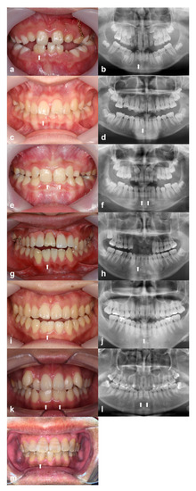 Comprehensive Genetic Exploration of Fused Teeth by Whole Exome Sequencing