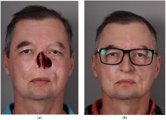 Implementation of Cone Beam Computed Tomography, Digital Sculpting and ...