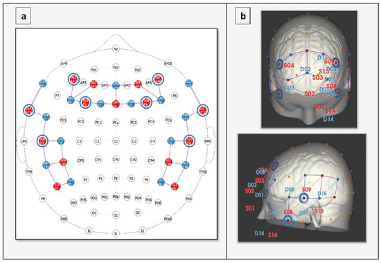 Cortical Activation in Response to Speech Differs between Prelingually Deafened Cochlear Implant ...