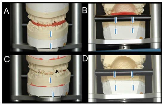 Planning the Aesthetics of the Mandibular Angles in Orthognathic ...