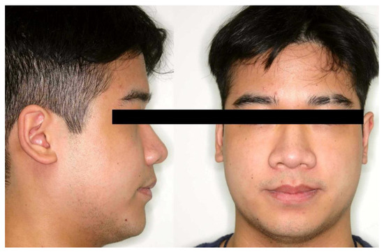 Planning the Aesthetics of the Mandibular Angles in Orthognathic ...