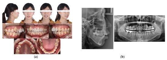An Orthodontic Treatment Case of a TMD Patient with Maxillary Posterior ...