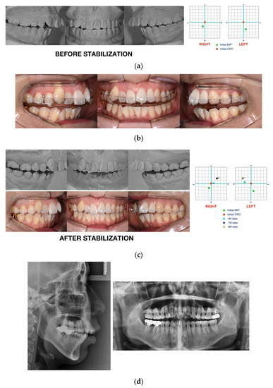 Applied Sciences | Free Full-Text | An Orthodontic Treatment Case of a ...