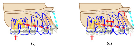 An Orthodontic Treatment Case of a TMD Patient with Maxillary Posterior Intrusion Using TSADs